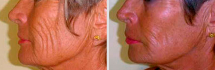 bio-lifting-ergebnis-01 - Cosmoderm